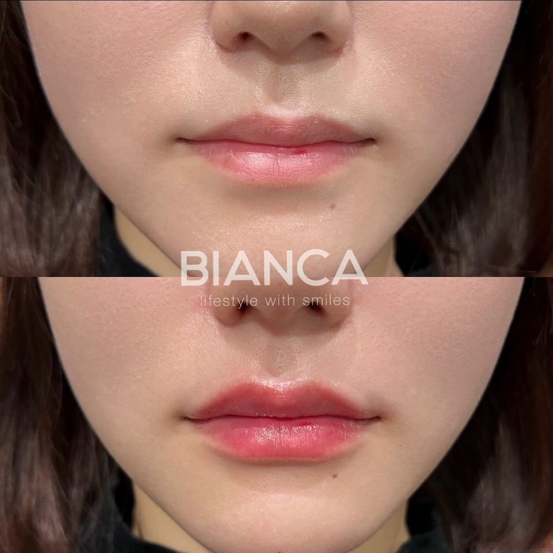 Lips Filler for Every Ethnicity: Subtle Results with Cosmetic Surgery ...