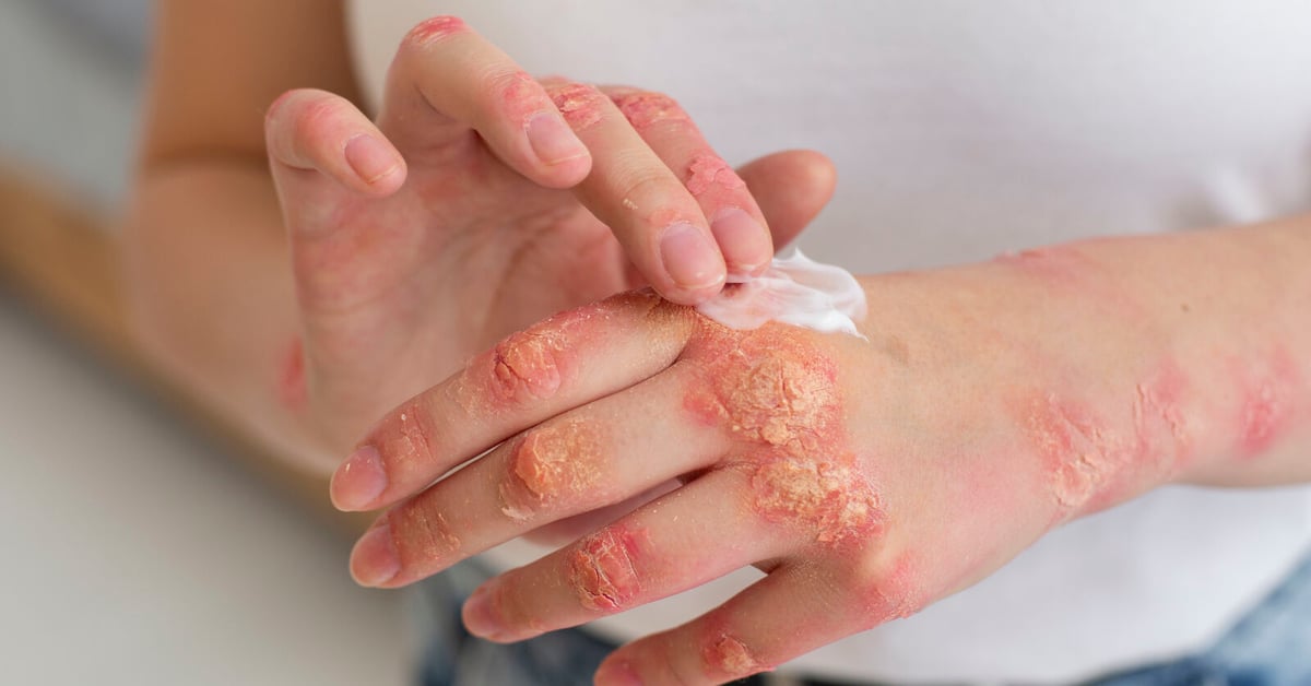 Understanding Psoriasis Through a Picture: A Visual Insight into the ...
