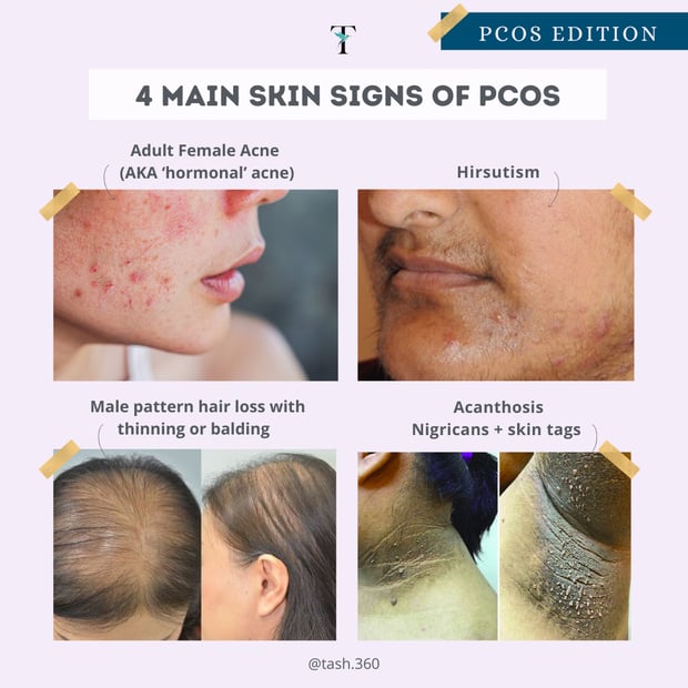 Dermatologist Explains Link Between PCOS and Your Skin - Longevity LIVE
