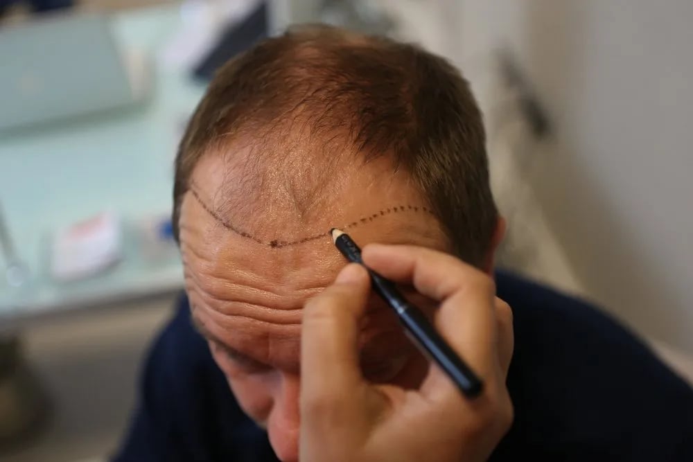 Unlocking Confidence: The Journey of Hair Transplant
