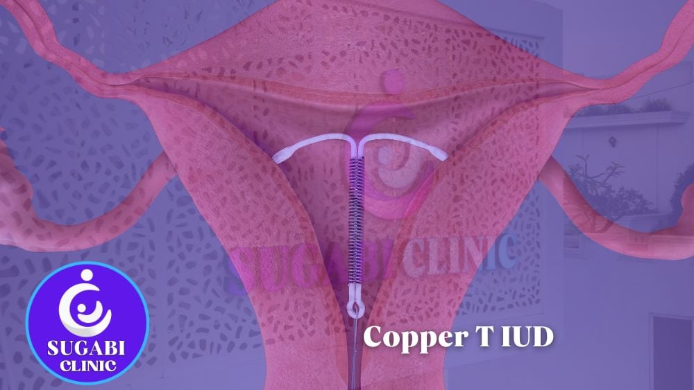 Copper T IUD: A Safe, Effective, and Long-Acting Contraceptive Option - Sugabi Clinic Patient ...