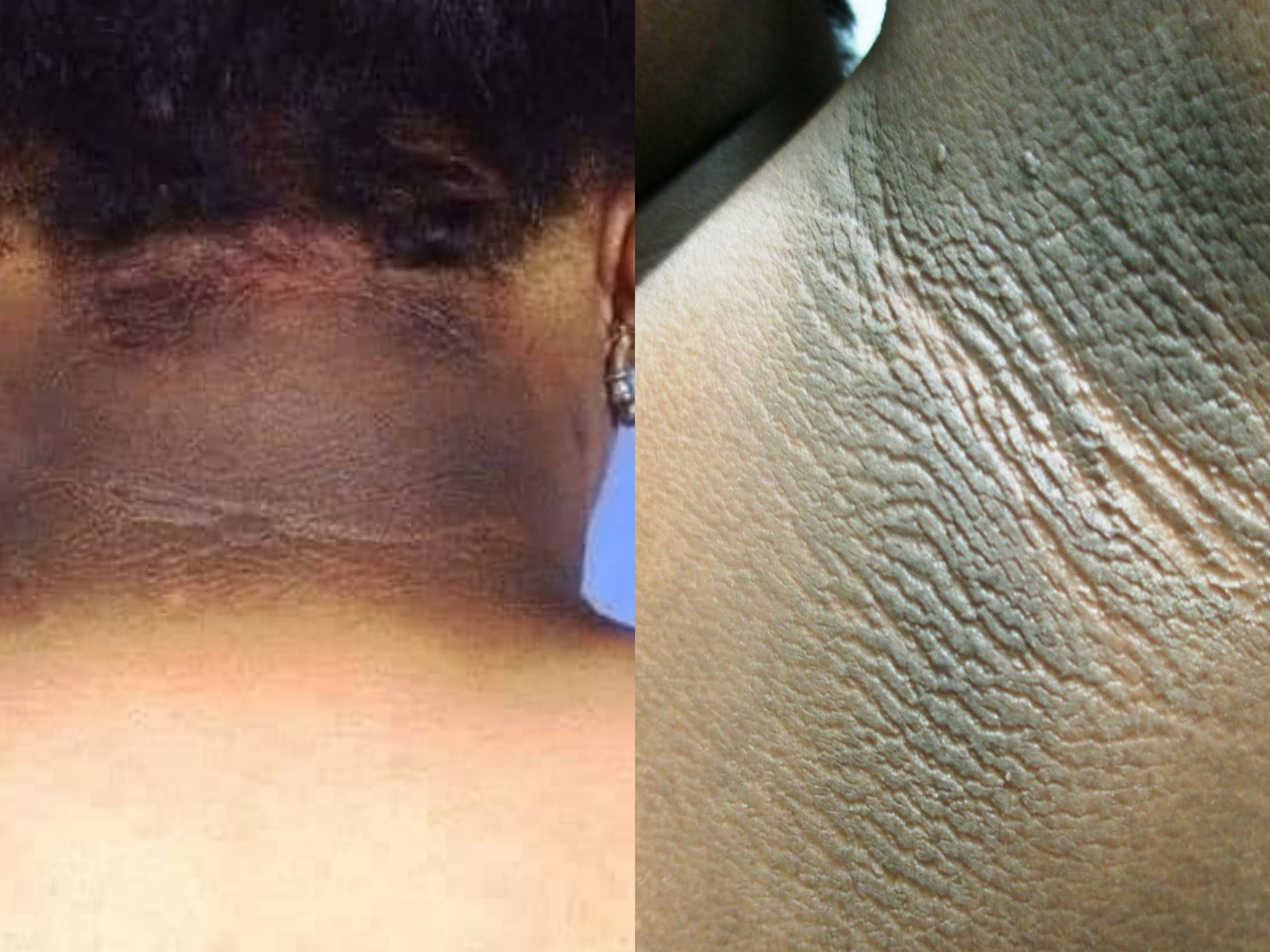 Saiba o que é "Acantose Nigricans" uma doença erradamente associada a ...