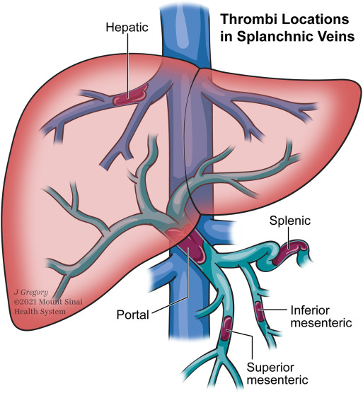 Vascular Liver Disease Group Reports on Dangerous Splanchnic Vein ...