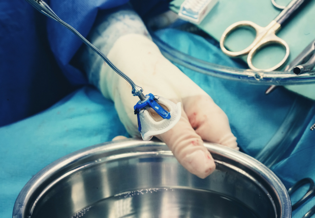First Patient Visit APOLLO Transcatheter Mitral Valve Replacement (TMVR ...