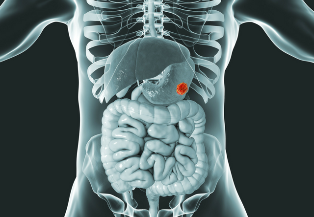 Next-Generation Sequencing for Gastric and GEJ Cancer