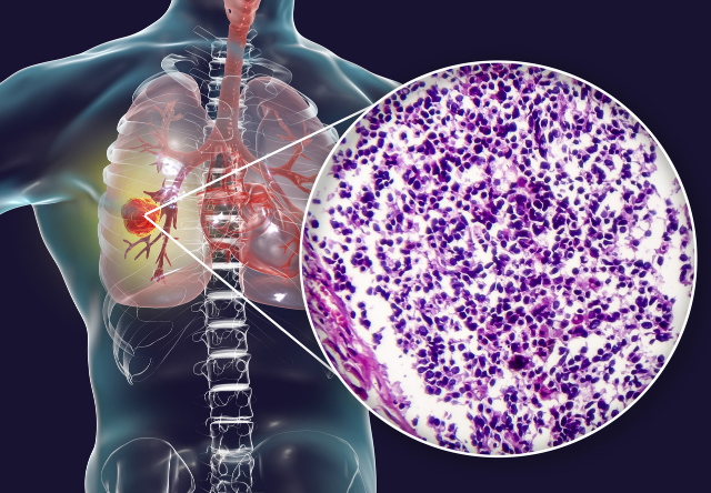 Genetech Receives FDA Approval for Rozlytrek (entrectinib) for the ...