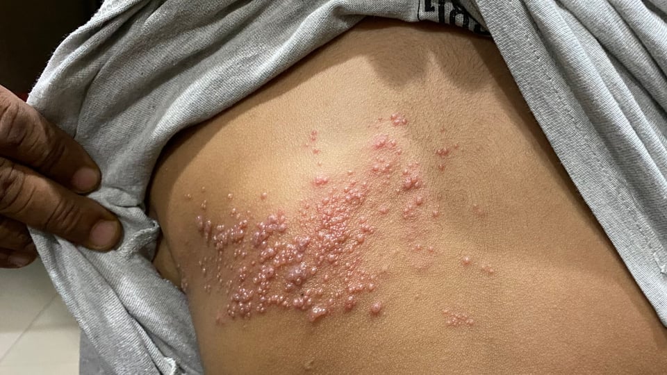 Beyond the Rash: Protecting At-Risk Australians during Global Shingles ...