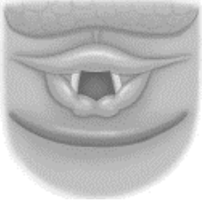 A classificação de Cormack-Lehane modificada da via aérea do...