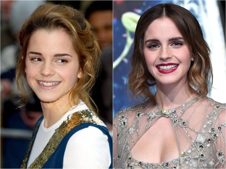 Brace yourself: Here are 7 celebs who owe their million-dollar smiles ...
