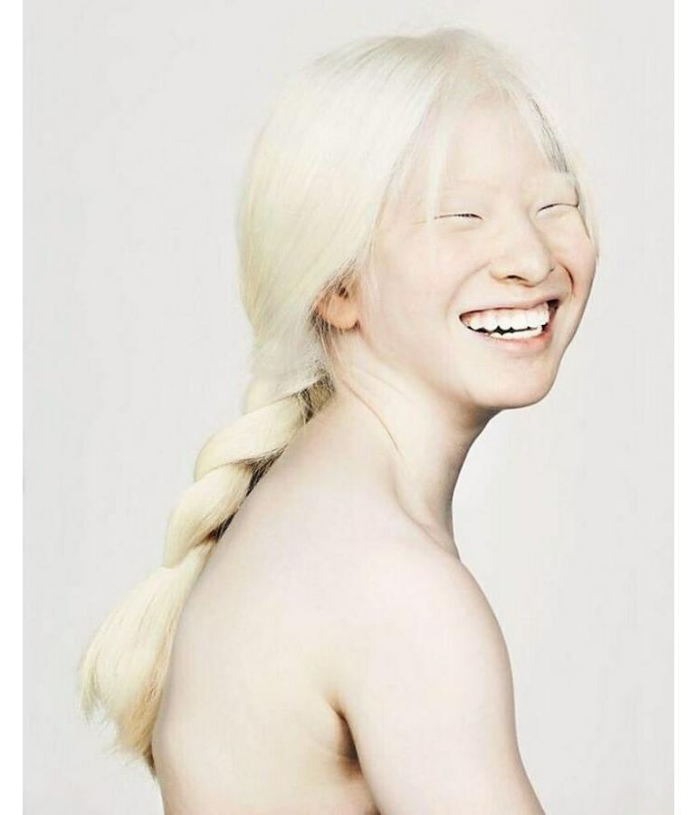 Abandoned as a baby in China because of the way she looked, this Albino ...
