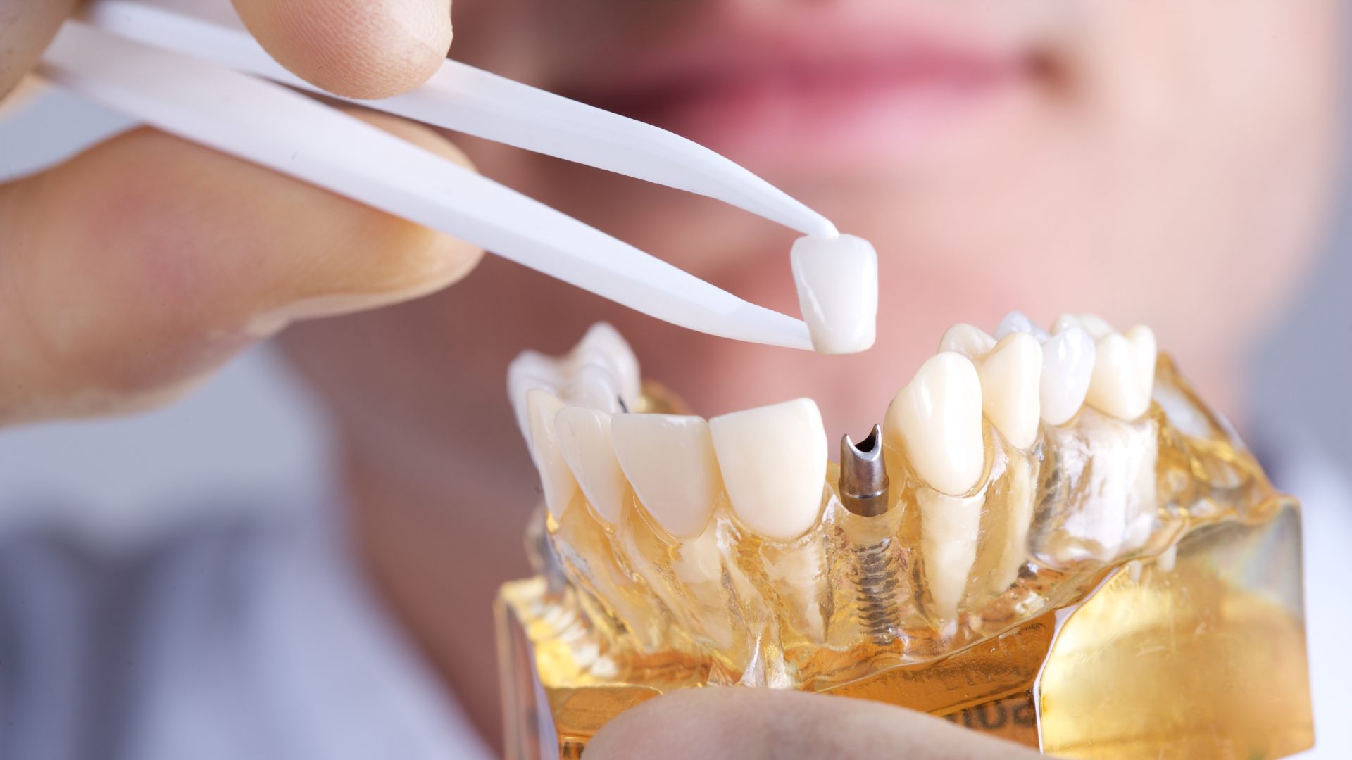 Zygomatic Dental Implants Turkey | Smile Center Turkey®
