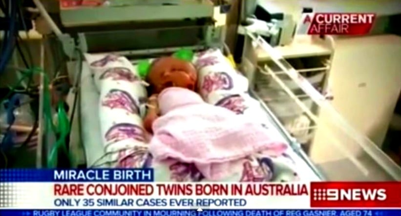 Rare Conjoined Twins With One Body and Two Faces Born in Australia
