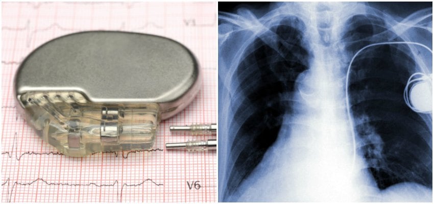 Health Canada warns depleting pacemaker batteries causing patients to ...