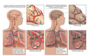Normal Lung vs. Emphysemic Lung : Medical Illustration