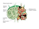 Normal Lung vs. Emphysemic Lung : Medical Illustration