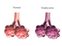 Normal Lung vs. Emphysemic Lung : Medical Illustration