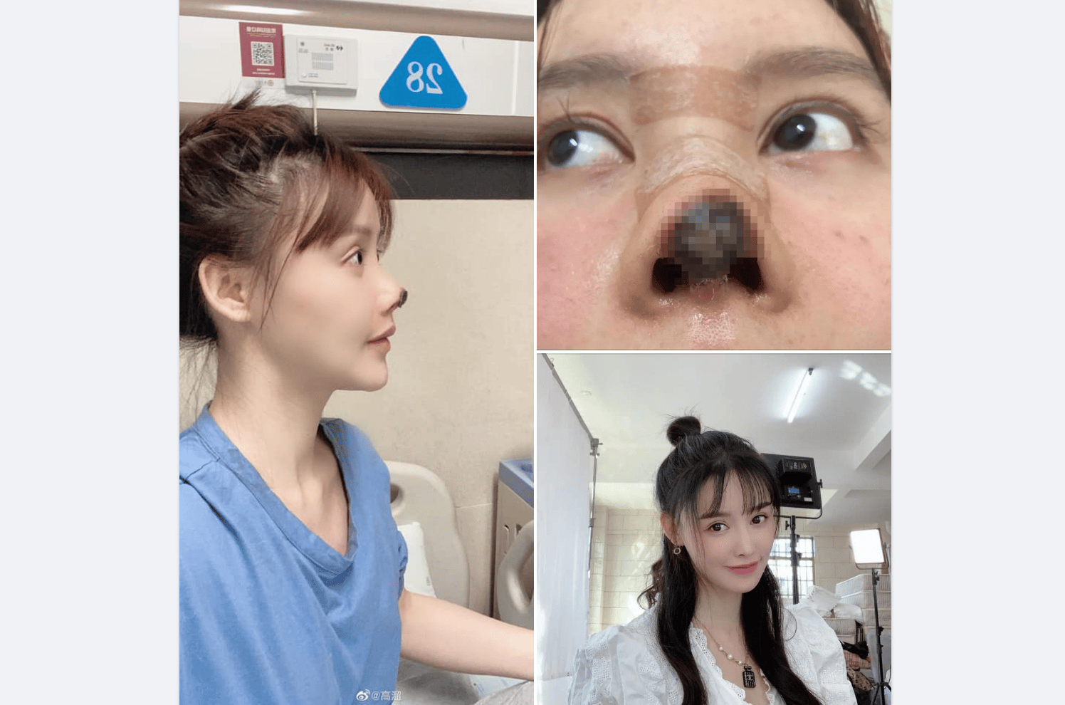 Chinese Actress Shares Photos of Her Botched Nose Surgery | Courthouse ...